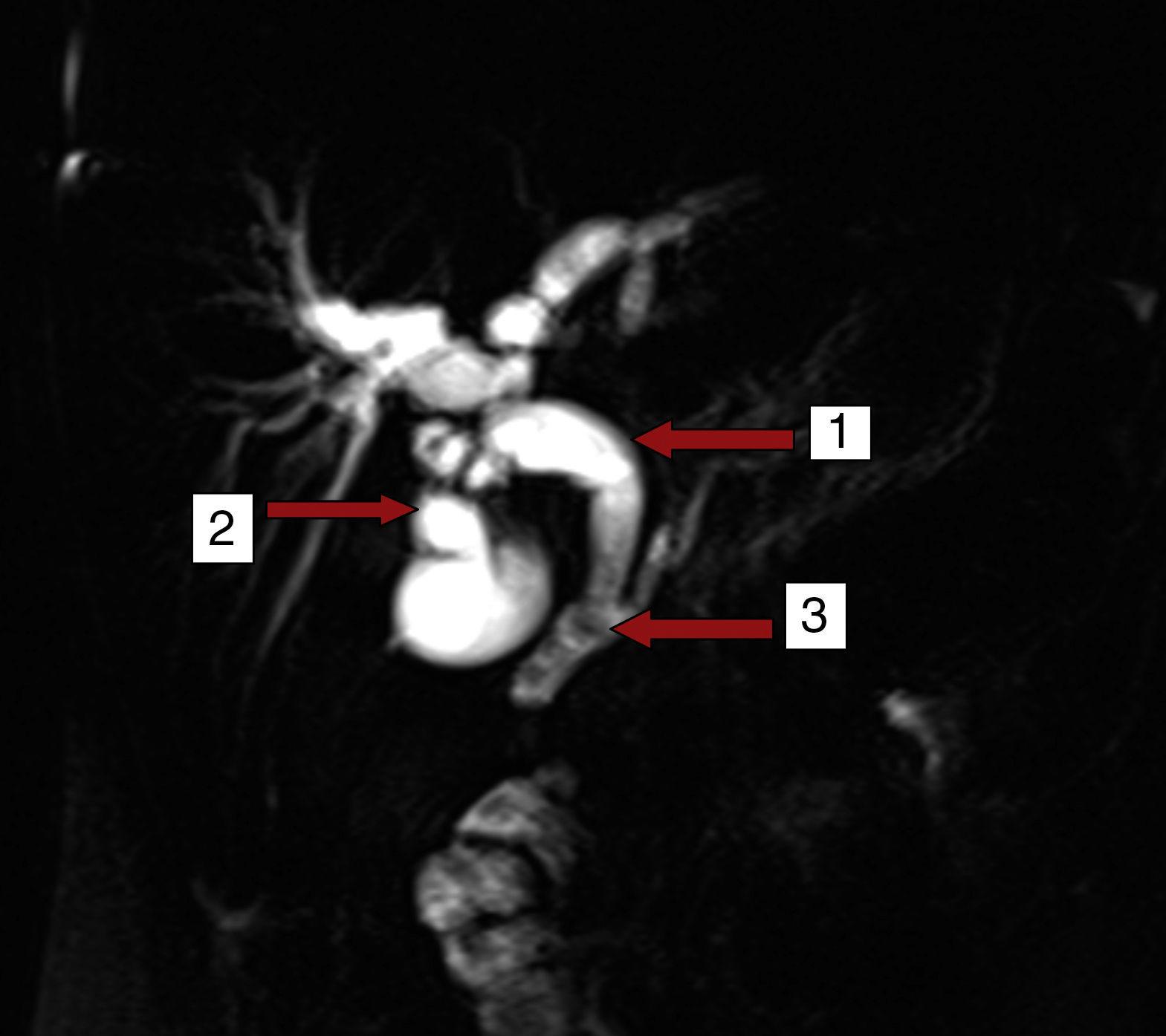 Colestasis y pancreatitis como forma de presentación de quiste de ...
