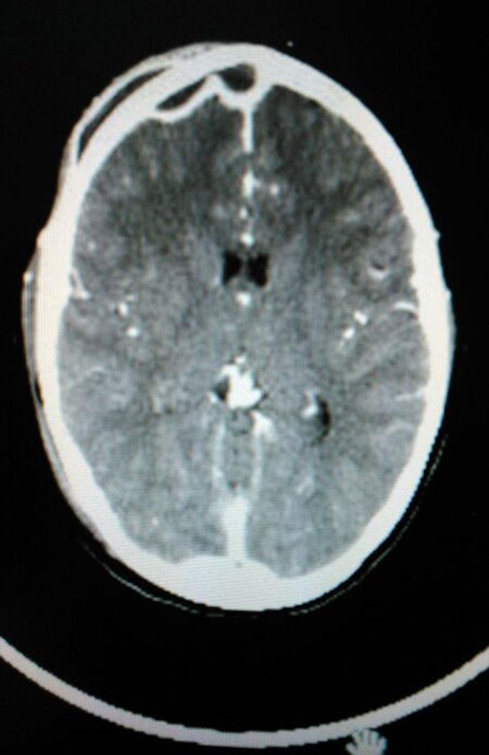 Absceso epidural y sinusitis frontal | Anales de Pediatría