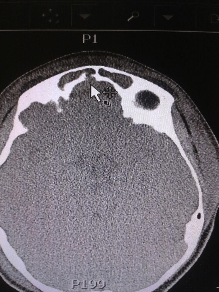 Absceso epidural y sinusitis frontal | Anales de Pediatría