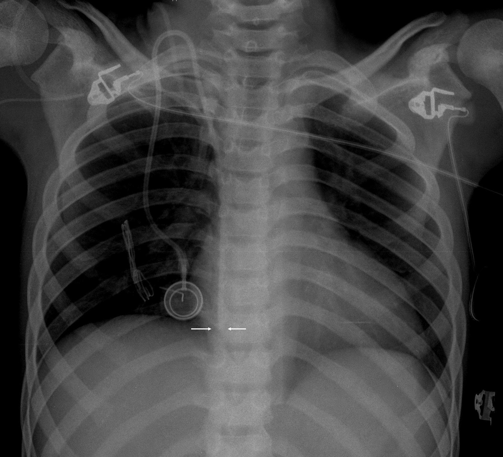 Taponamiento cardiaco atípico por reservorio venoso central. ¿Podemos ...