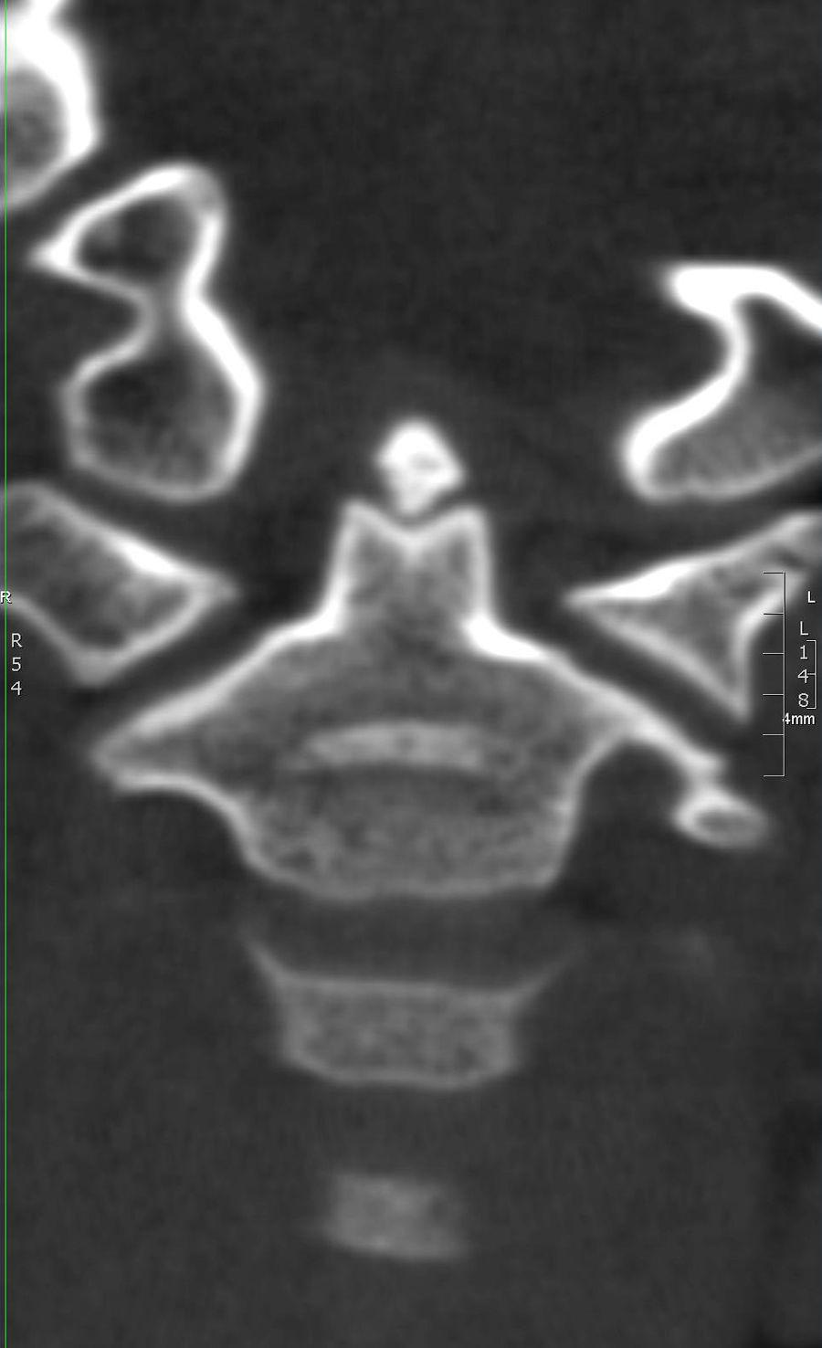 Ossiculum terminale de Bergman. Una entidad poco conocida | Anales de ...