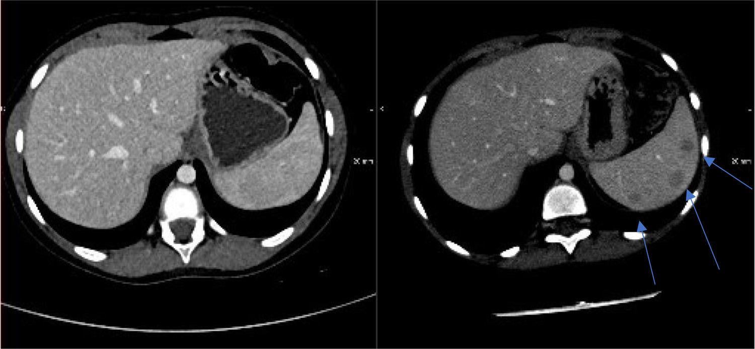 Granulomas esplénicos en una niña con enfermedad de Crohn | Anales de ...