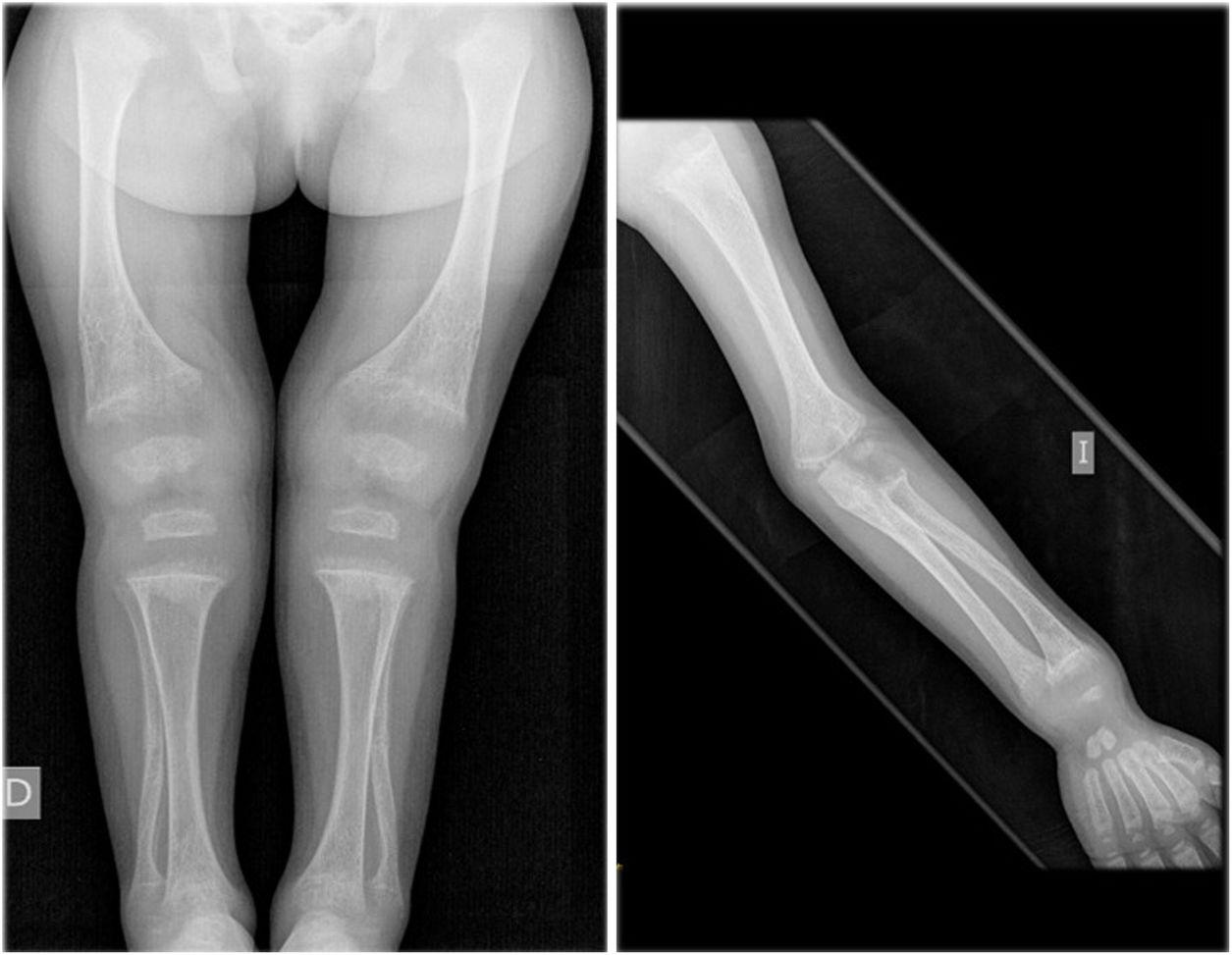 Raquitismo carencial en un paciente de raza negra | Anales de Pediatría