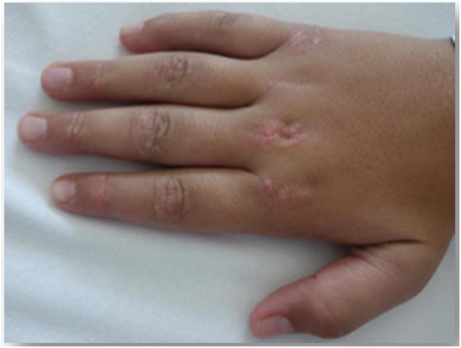 Dermatomiositis clínicamente amiopática con afectación pulmonar ...