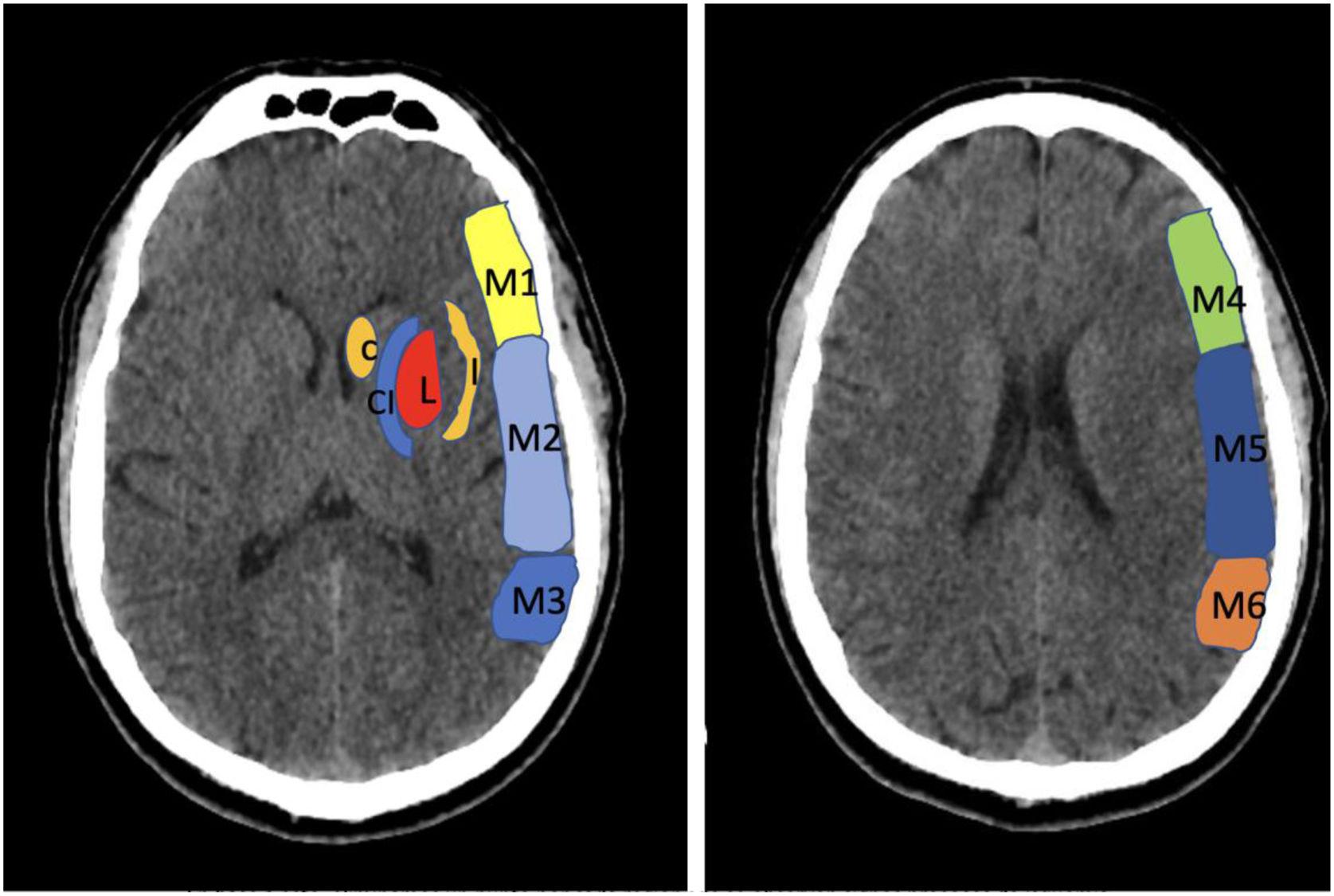 Tratamientos agudos de recanalización en el ictus arterial isquémico ...