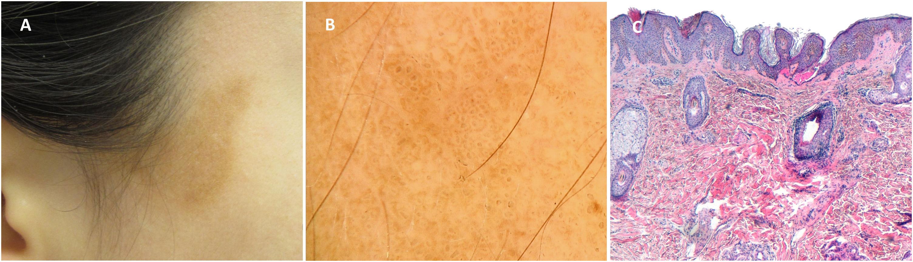 Acantosis nigricans nevoide: una entidad poco conocida | Anales de ...