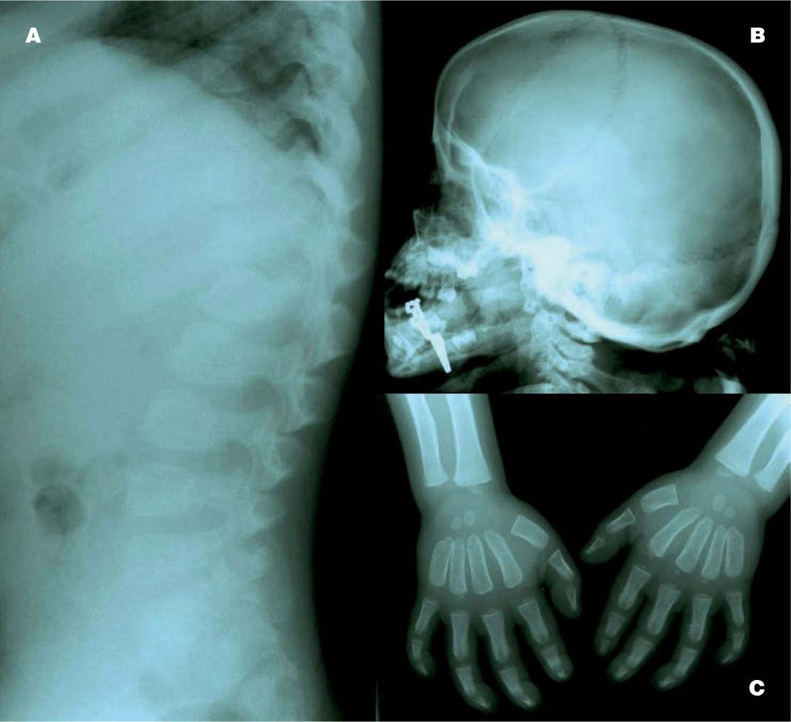 Tratamiento enzimático sustitutivo en las enfermedades lisosomales ...