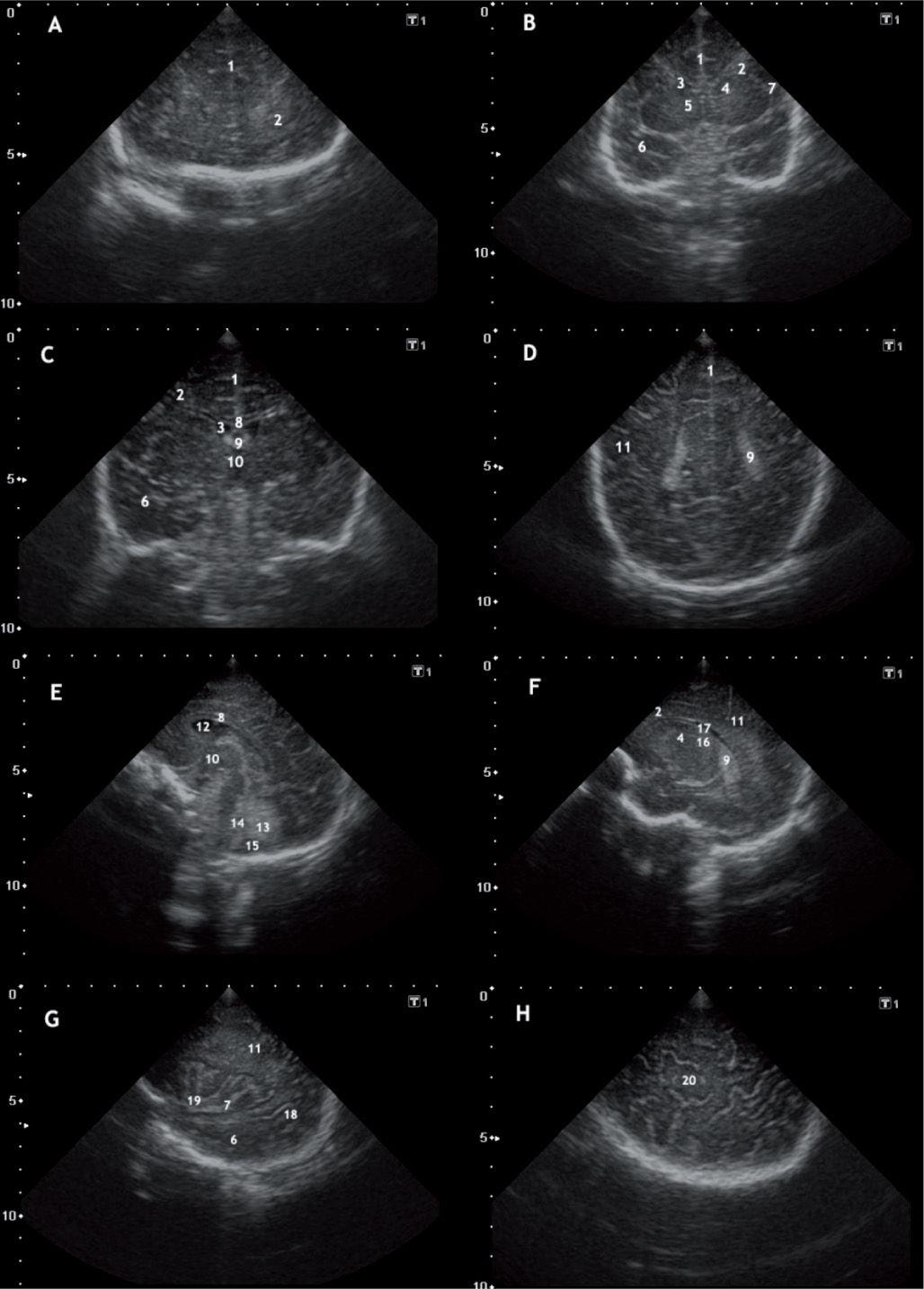 Ecografía cerebral en neonatos | Anales de Pediatría Continuada