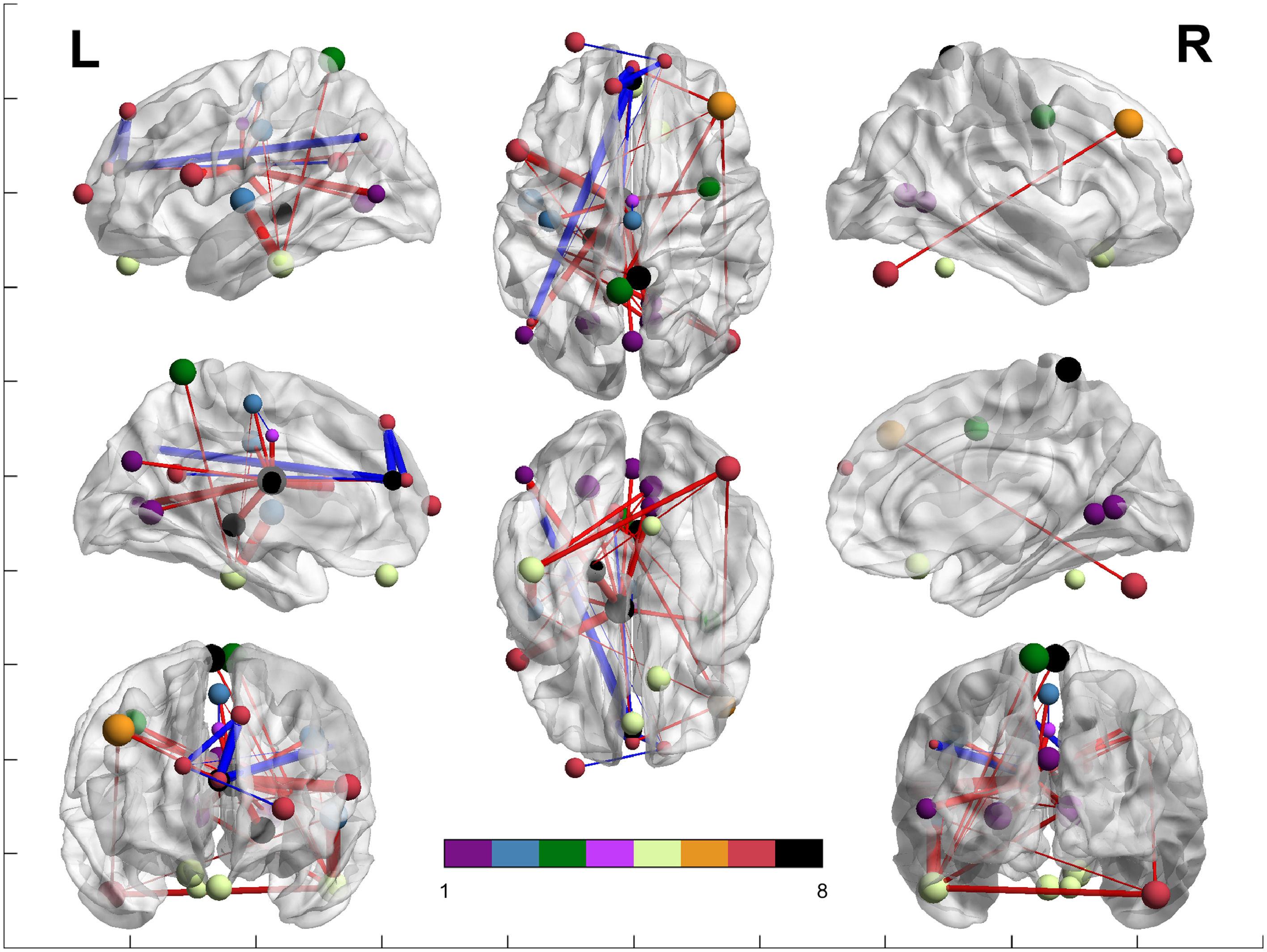 Abnormal degree centrality and functional connectivity in Down syndrome ...