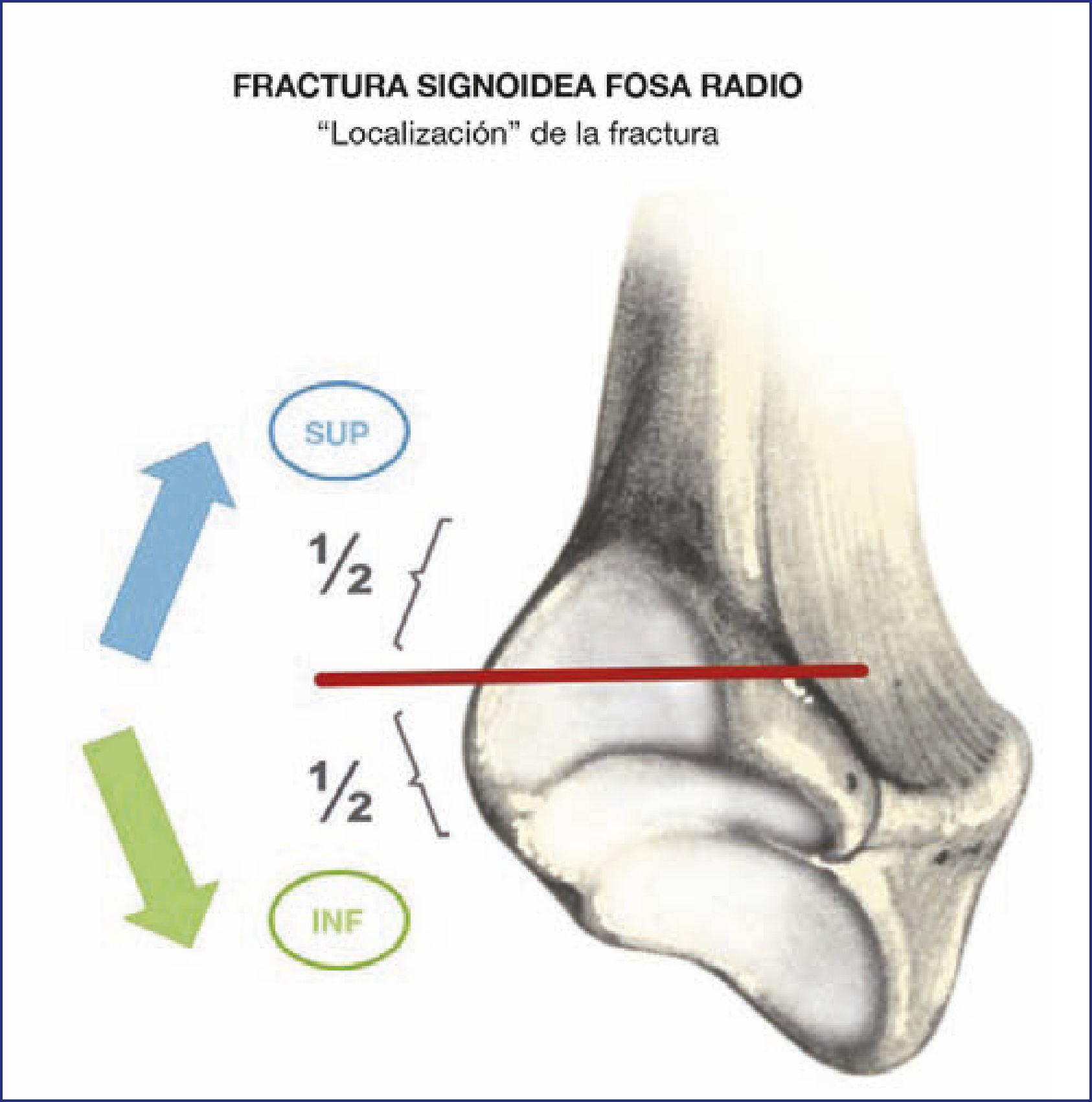 Nueva interpretación de los estabilizadores anatómicos en la fractura ...