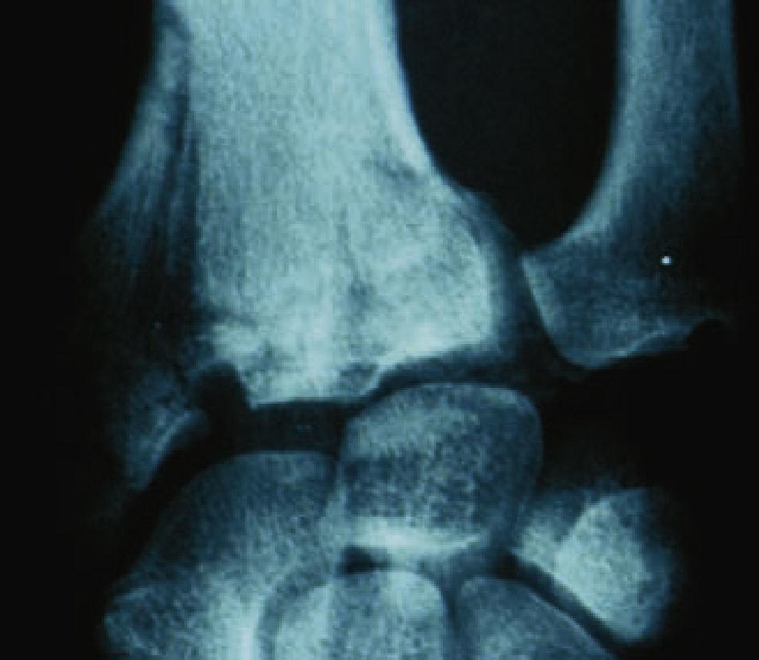 Nueva interpretación de los estabilizadores anatómicos en la fractura ...