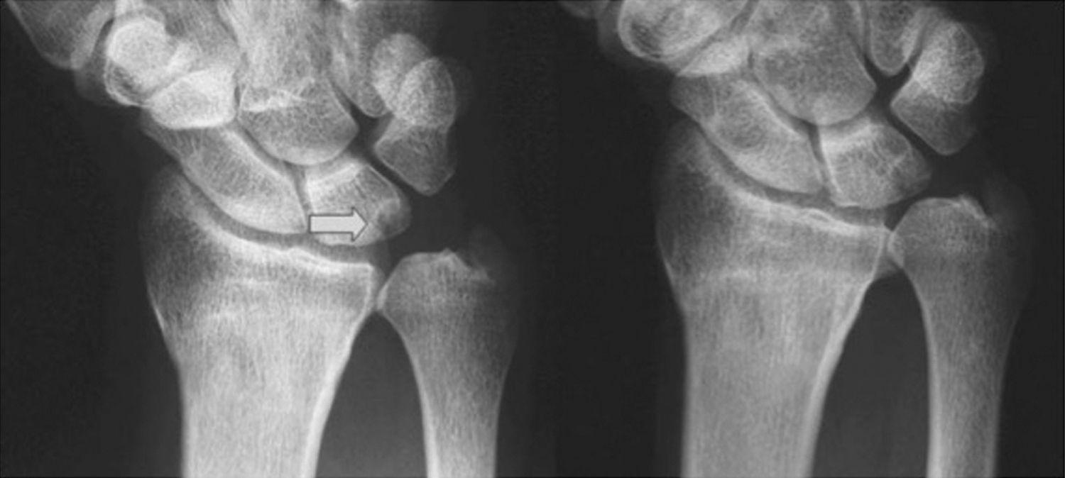Artrosis de la articulación radiocubital distal | Revista ...