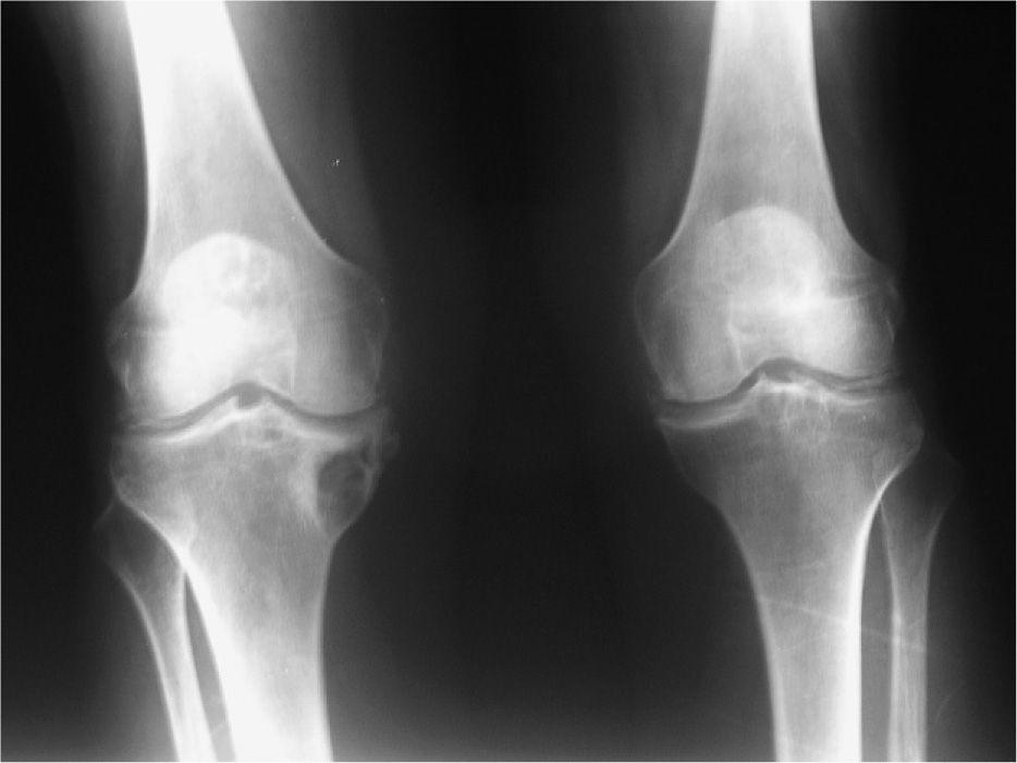 Condrocalcinosis e hipomagnesemia: evolución clinicorradiológica ...