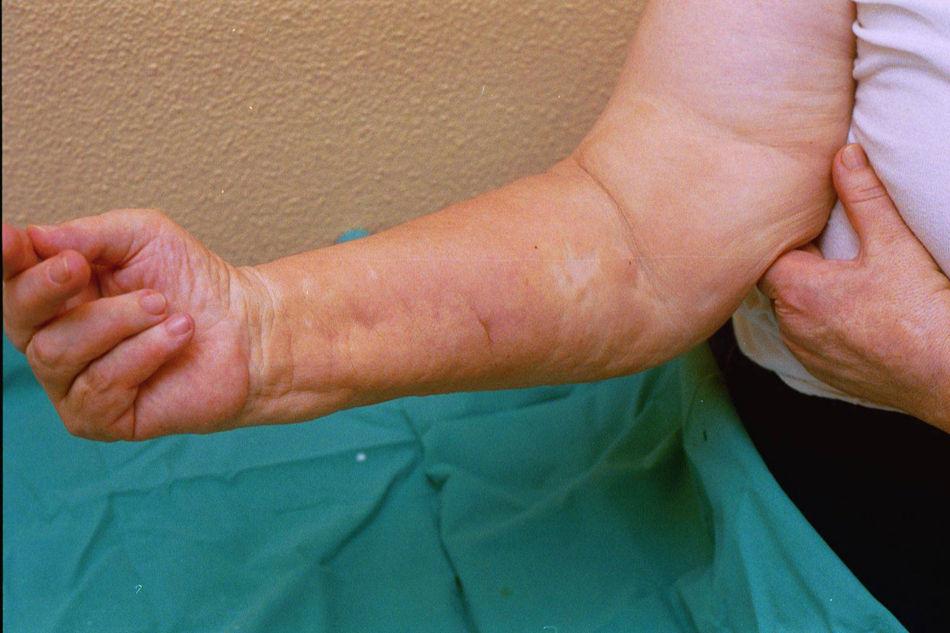 Nephrogenic systemic fibrosis in a patient with a p-ANCA systemic ...