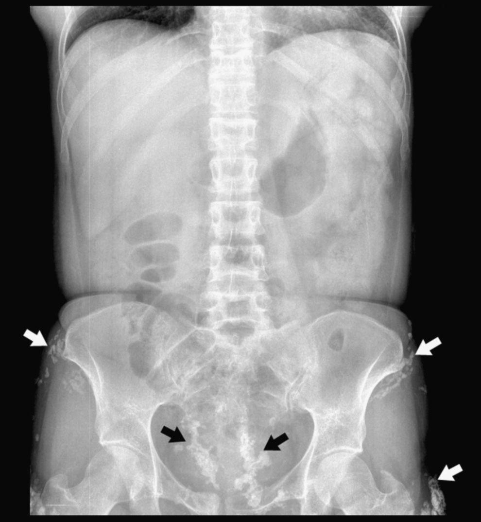 Calcinosis cutis en una paciente con lupus eritematoso sistémico ...