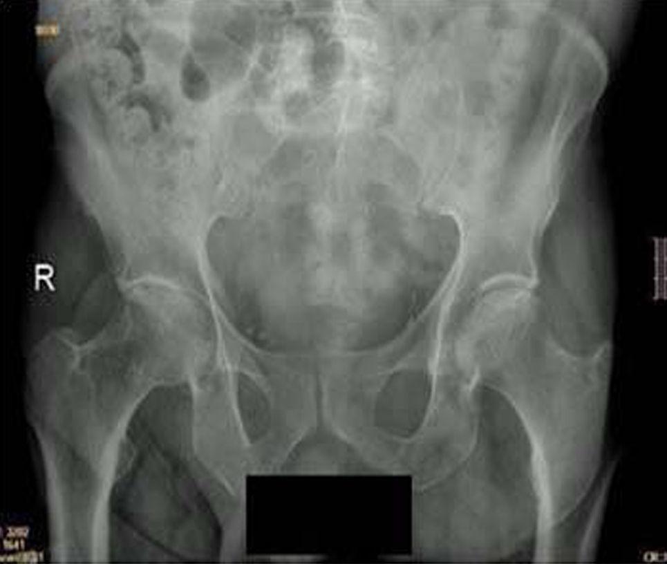 Osteoartritis rápidamente destructiva de cadera: a propósito de un caso ...