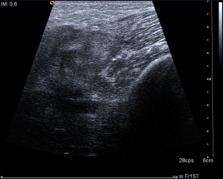 Pyomyositis of the inner thigh muscles due to Escherichia coli in a ...