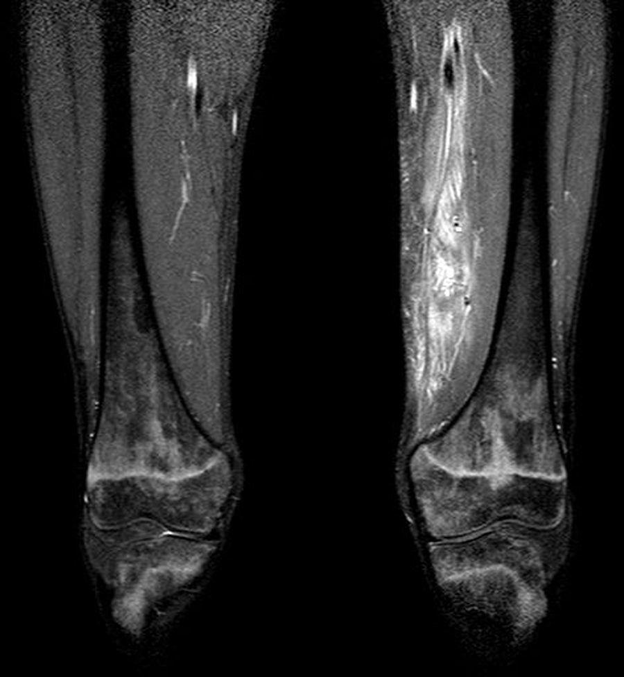 Pyomyositis of the inner thigh muscles due to Escherichia coli in a ...