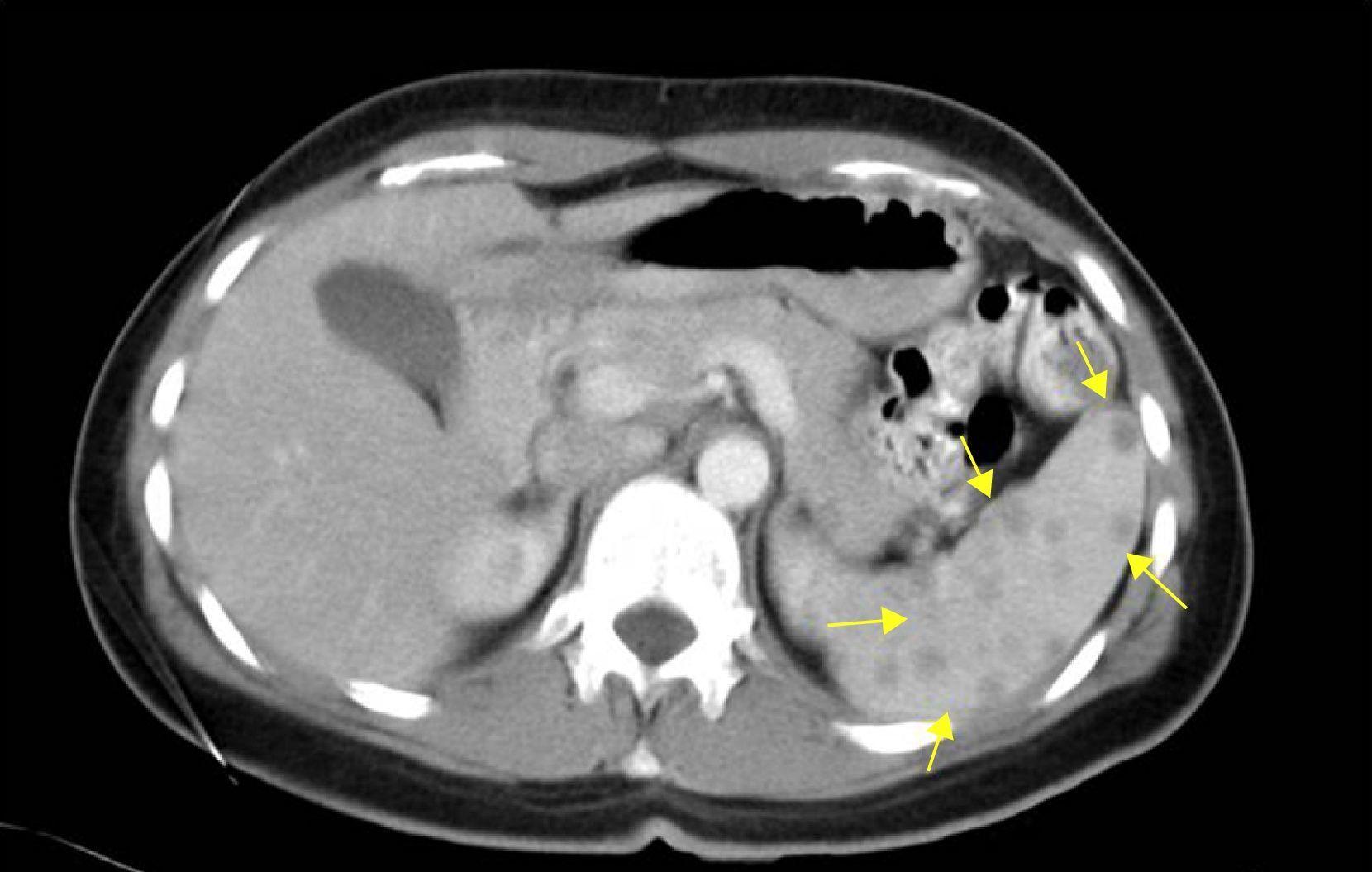 Sarcoidosis esplénica aislada | Reumatología Clínica