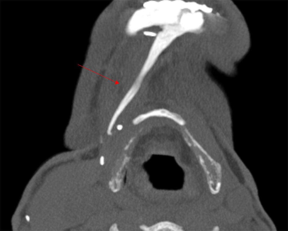 Miositis osificante en los músculos del cuello | Reumatología Clínica