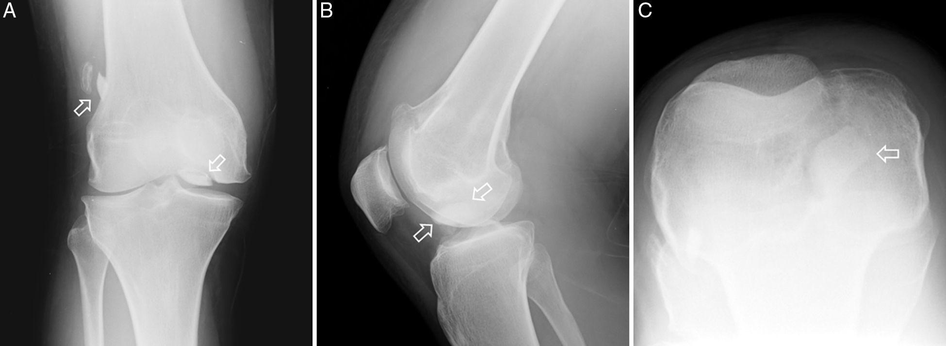 Hemartrosis de rodilla secundaria a osteocondritis disecante ...