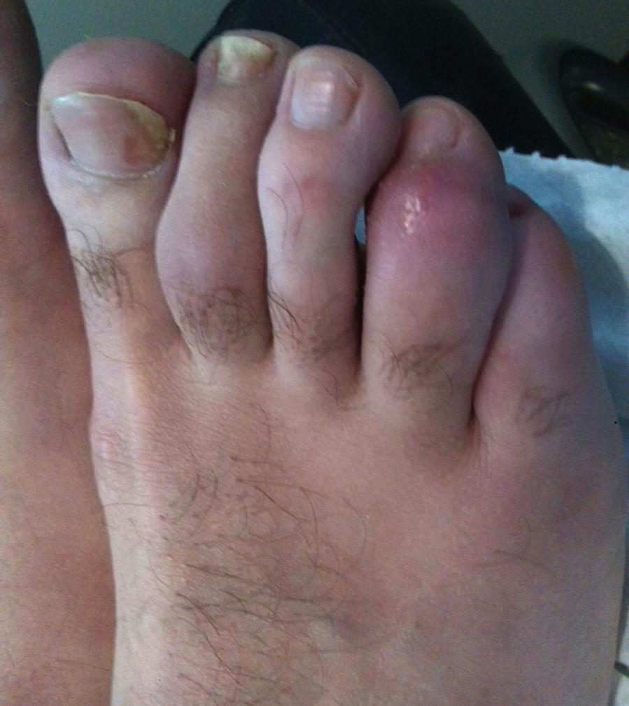 Rápida resolución de la dactilitis en un paciente con artritis ...