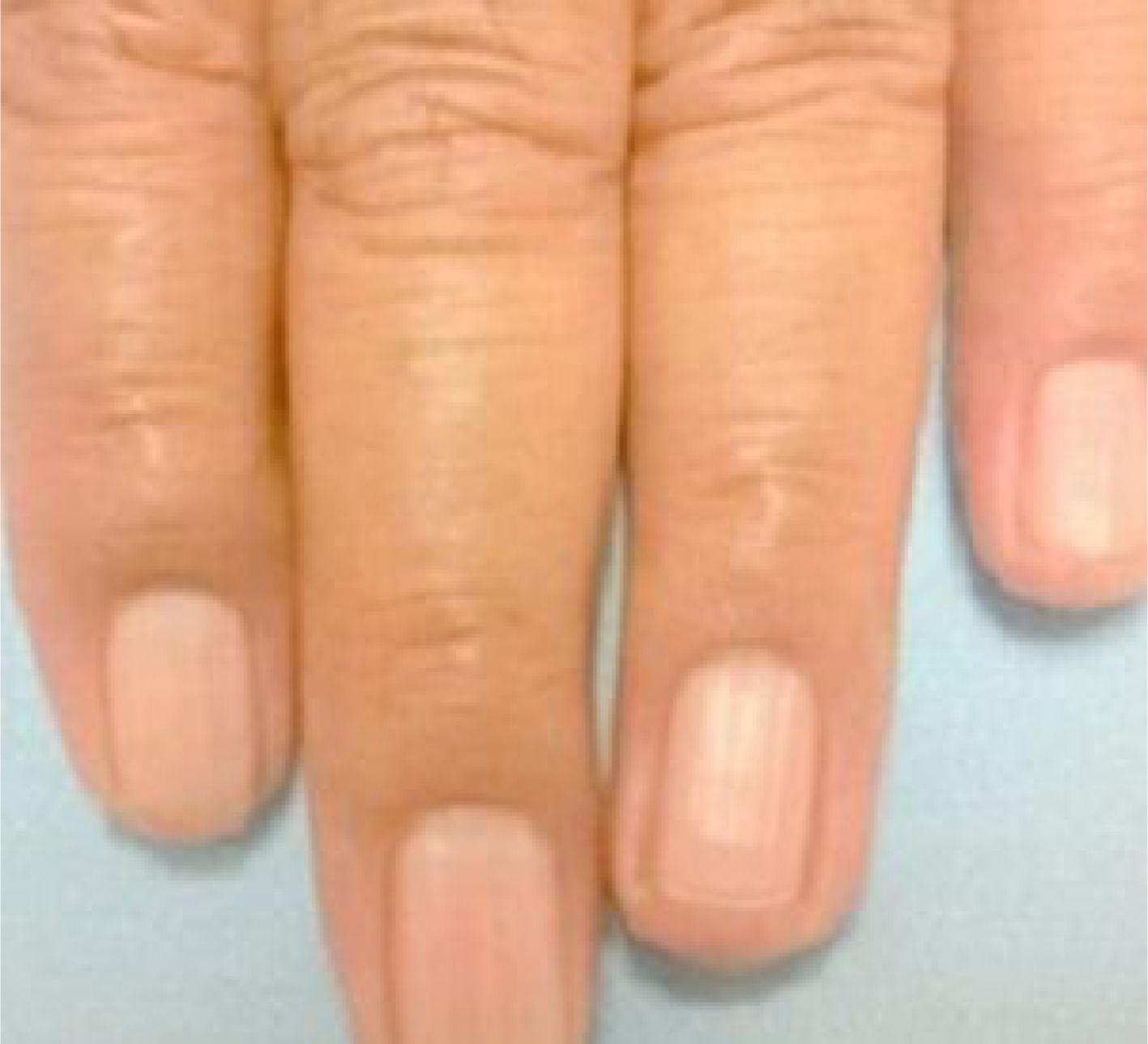 Flebectasia digital en un caso de poliangitis microscópica con ...