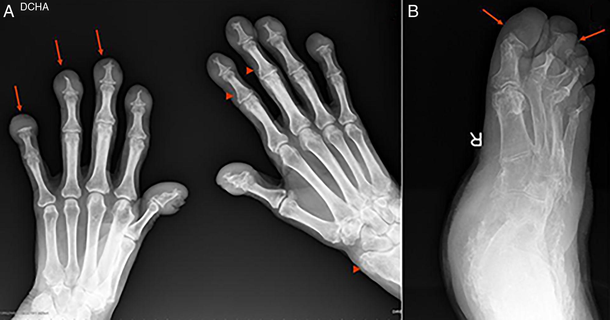 Hipocratismo digital: paciente con osteoartropatía hipertrófica y ...