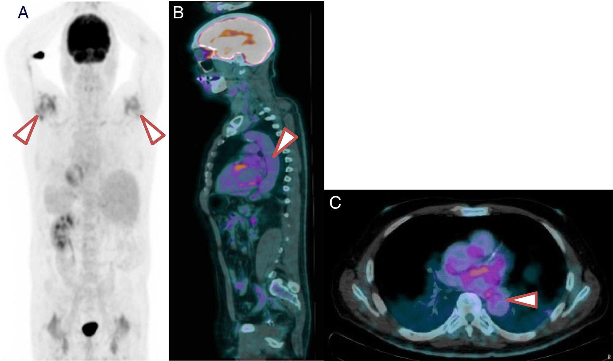 18 F-FDG PET/TC en pacientes con polimialgia reumática: despistando ...