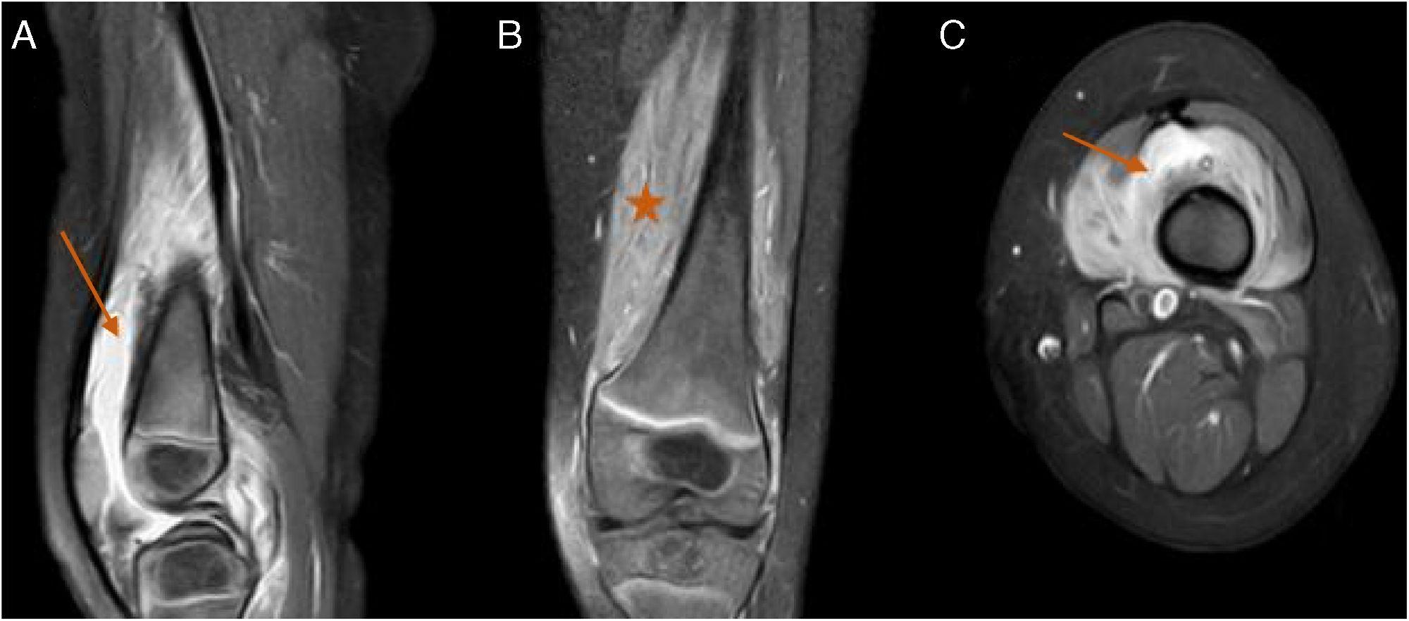 Artritis séptica como forma de inicio de una piomiositis | Reumatología ...