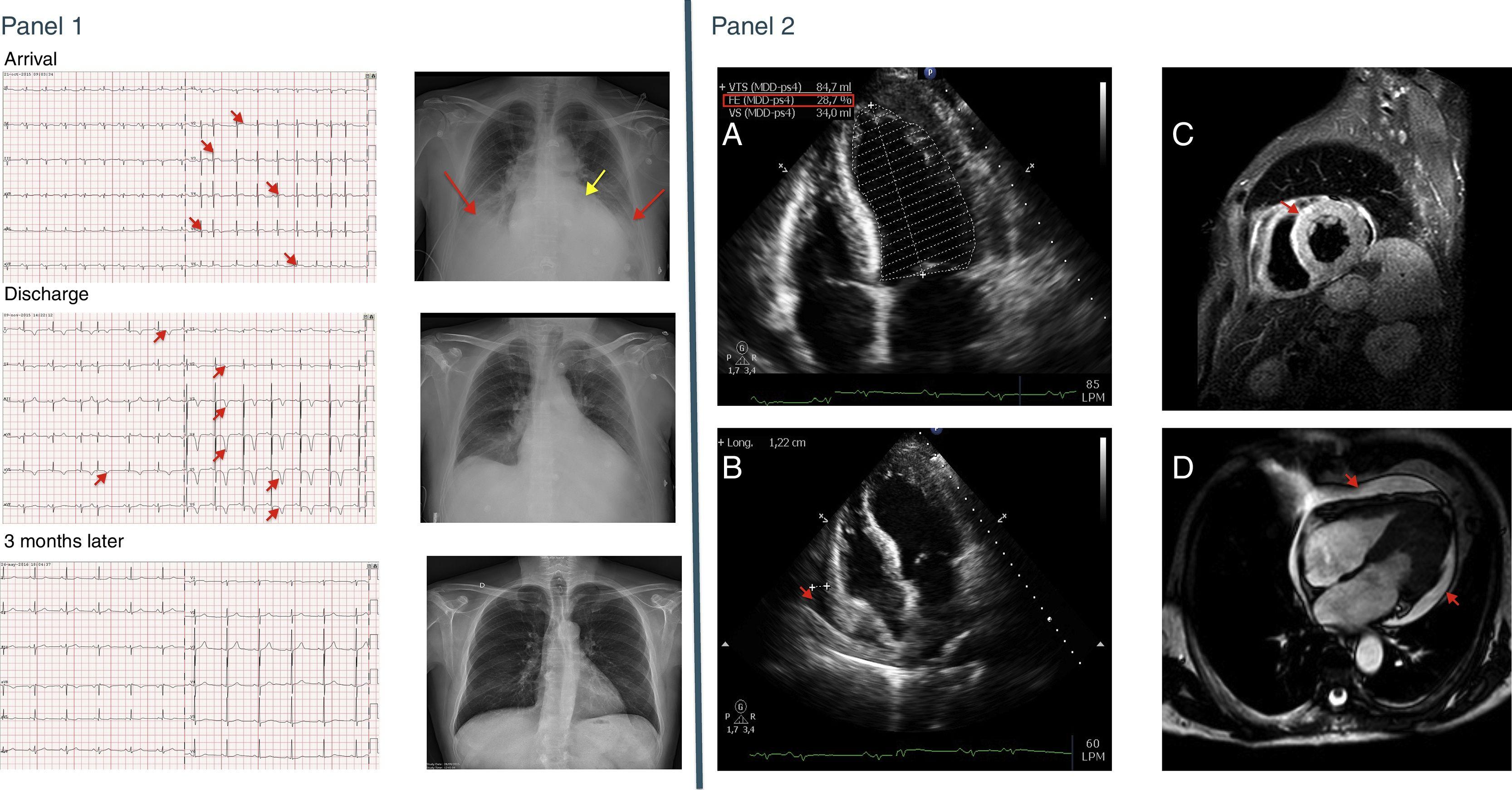 Scleroderma Renal Crisis: A Reversible Cause of Left Ventricular ...