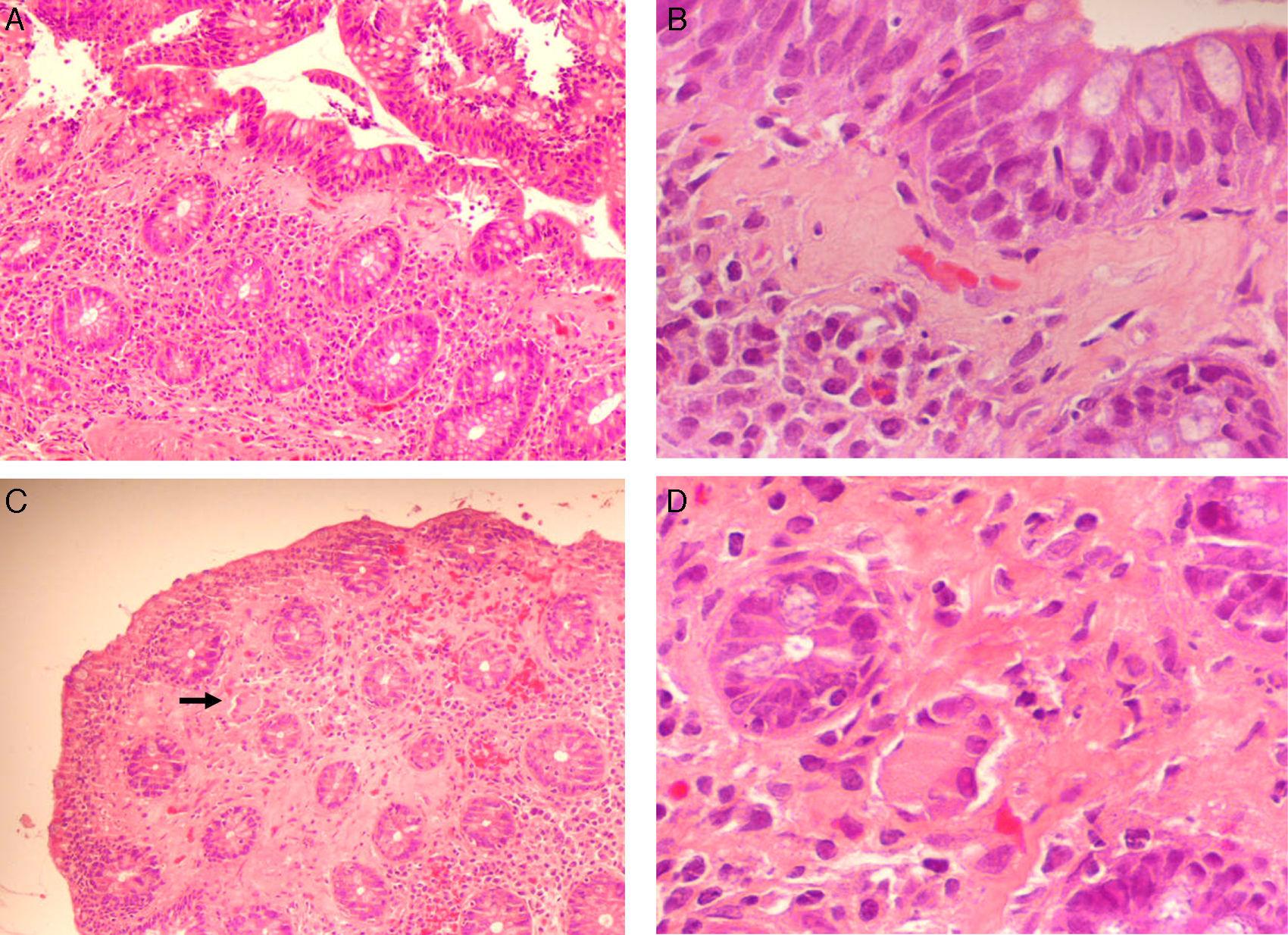 Colitis microscópica atípica: descripción de 2 casos de colitis ...