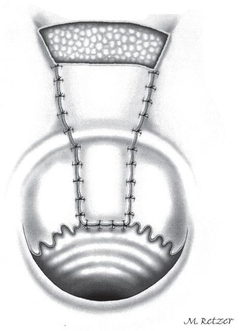 SURGICAL TREATMENT OF ANAL STENOSIS: ASSESSMENT OF 77 ANOPLASTIES | Clinics