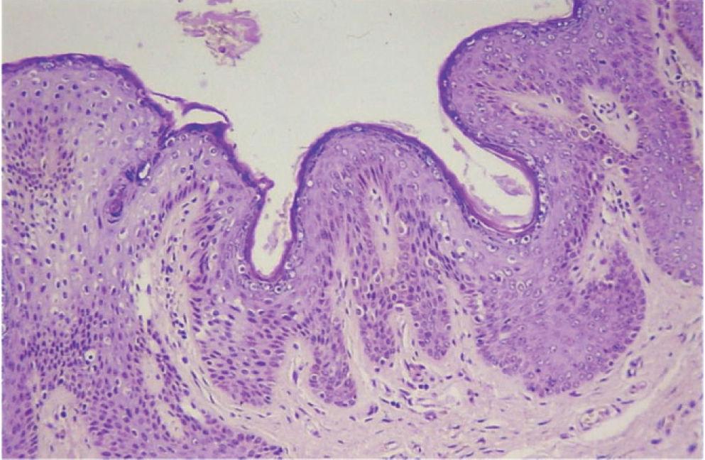 Acanthosis Nigricans Histology