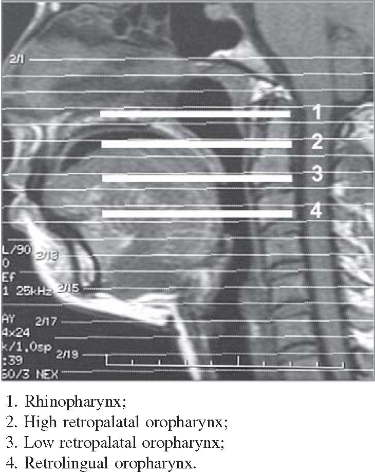 PHARYNGEAL DIMENSIONS IN HEALTHY MEN AND WOMEN | Clinics