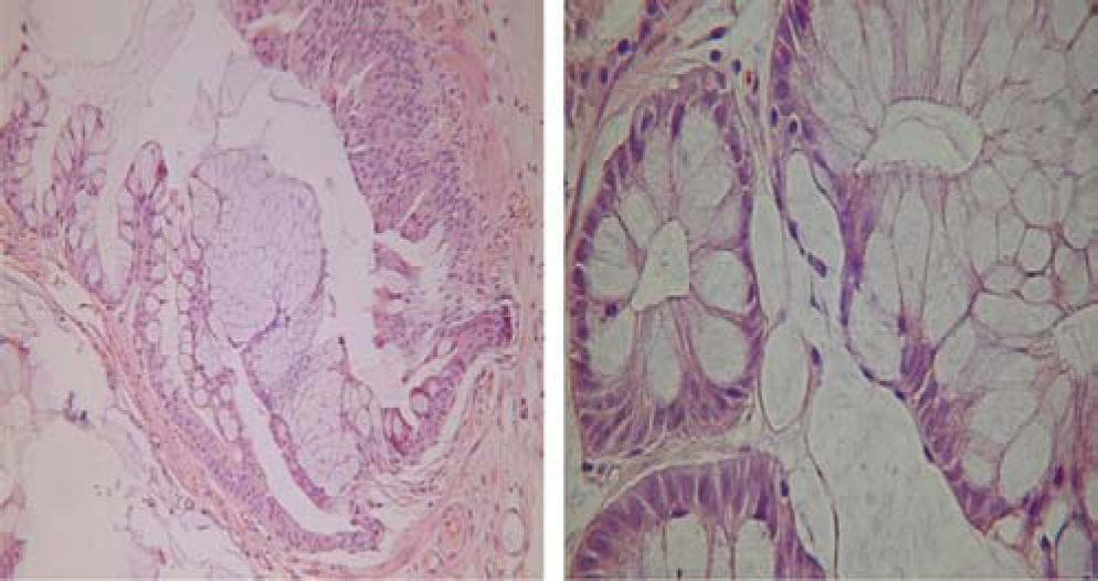 GLANDULAR CYSTITIS – A RARE BENIGN CONDITION PRESENTING AS A PSEUDO ...
