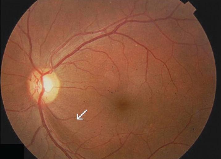 RETINAL NERVE FIBER LAYER DEFECT IN A PATIENT WITH HEALTHY NEURORETINAL ...