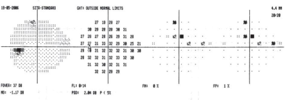 RETINAL NERVE FIBER LAYER DEFECT IN A PATIENT WITH HEALTHY NEURORETINAL ...
