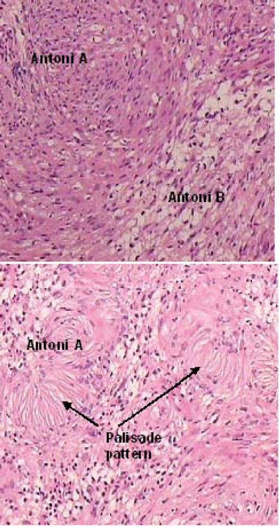 RETROPERITONEAL SCHWANNOMA: CASE SERIES AND LITERATURE REVIEW | Clinics