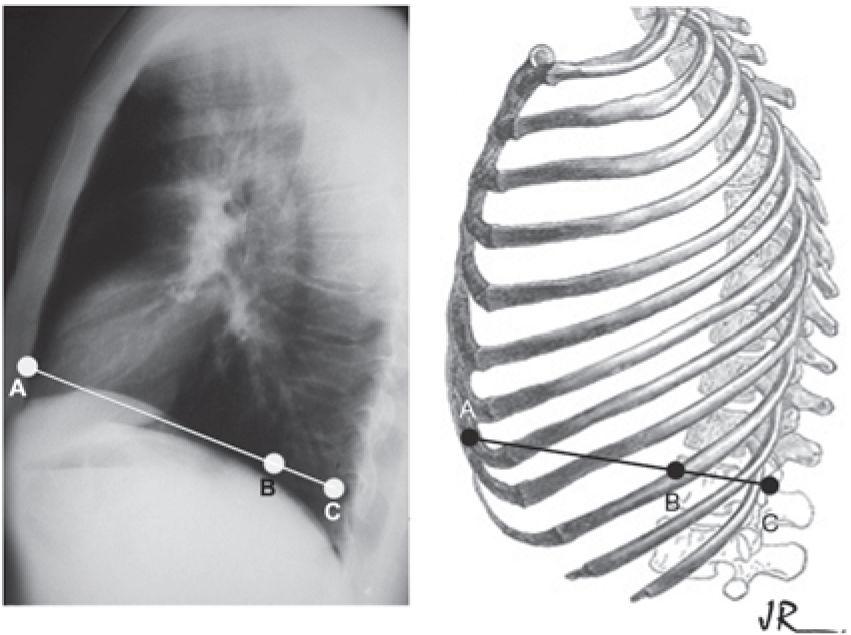ANTHROPOMETRIC INDEX FOR PECTUS EXCAVATUM | Clinics
