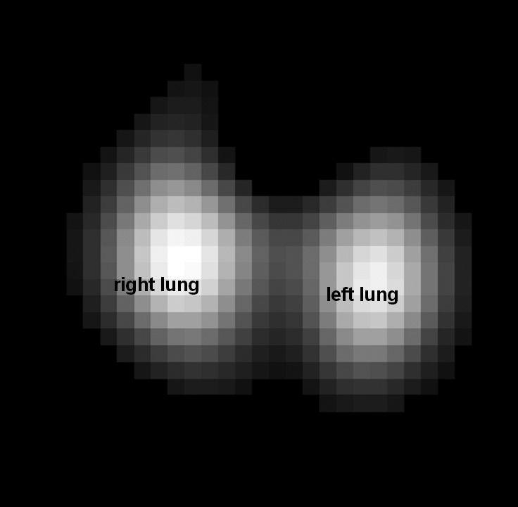 Fuzzy Modeling of Electrical Impedance Tomography Images of the Lungs ...