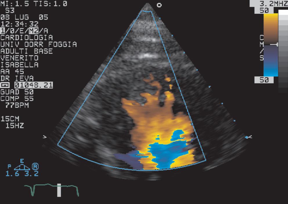A Case of Pseudo-Hypertrophic Cardiomyopathy: A Congenital Heart ...