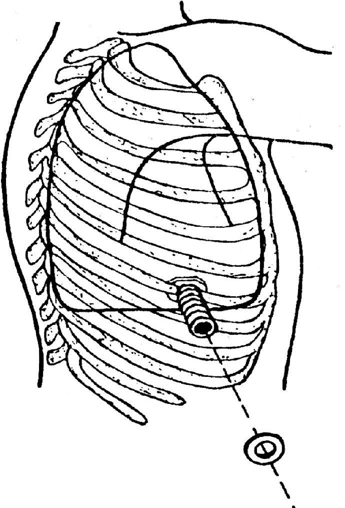 Prosthesis for Open Pleurostomy (POP): Management for Chronic Empyemas ...