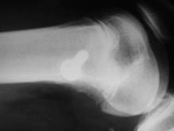 Femoral Mechanical-Biological Graft Fixation in ACL Reconstruction in ...