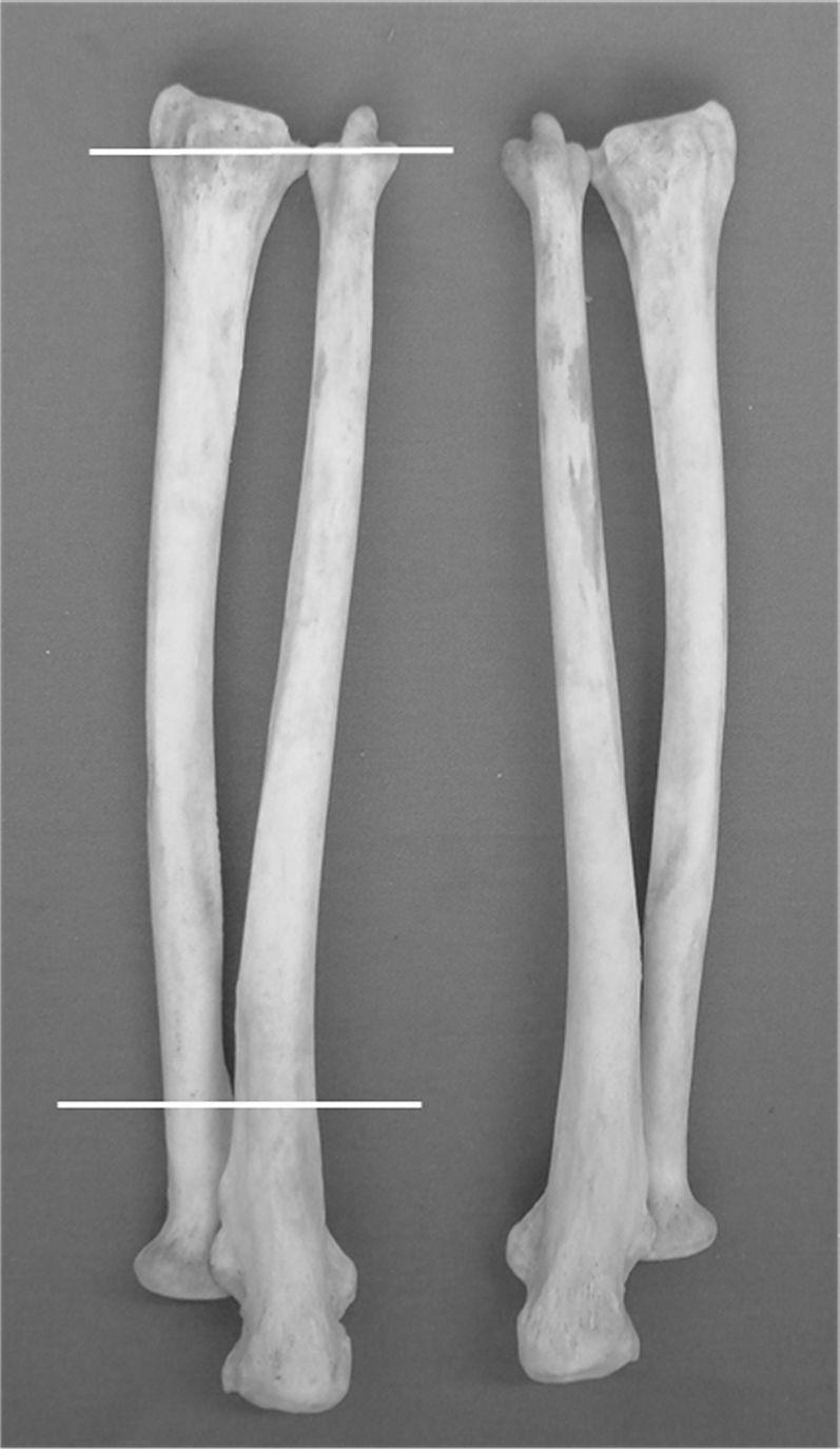 Intraobserver and interobserver reliability of radial torsion angle ...