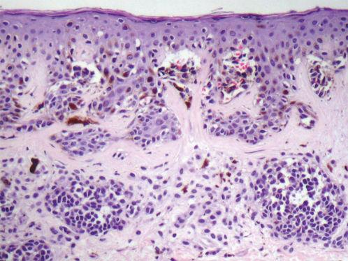 Atypical mole syndrome and dysplastic nevi: identification of ...