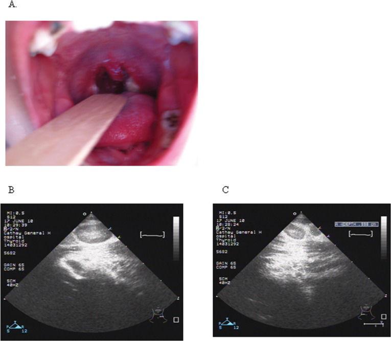 An atypical presentation of Kawasaki disease: a 10-year-old boy with ...