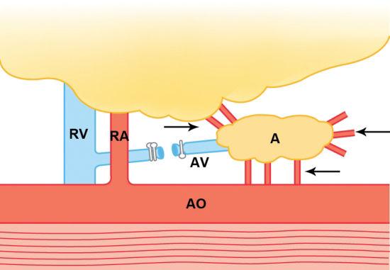 Retroperitoneoscopic adrenalectomy in pheochromocytoma | Clinics