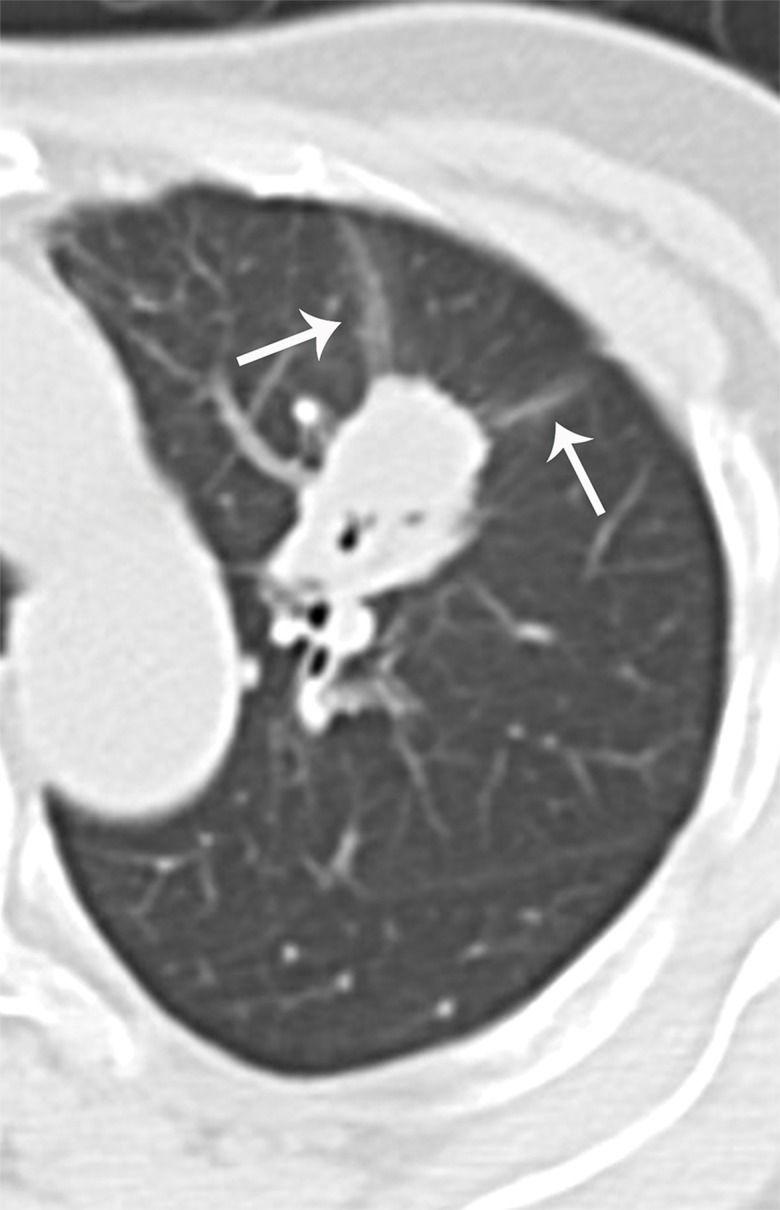 Differential Diagnosis of Solitary Pulmonary Inflammatory Lesions and ...