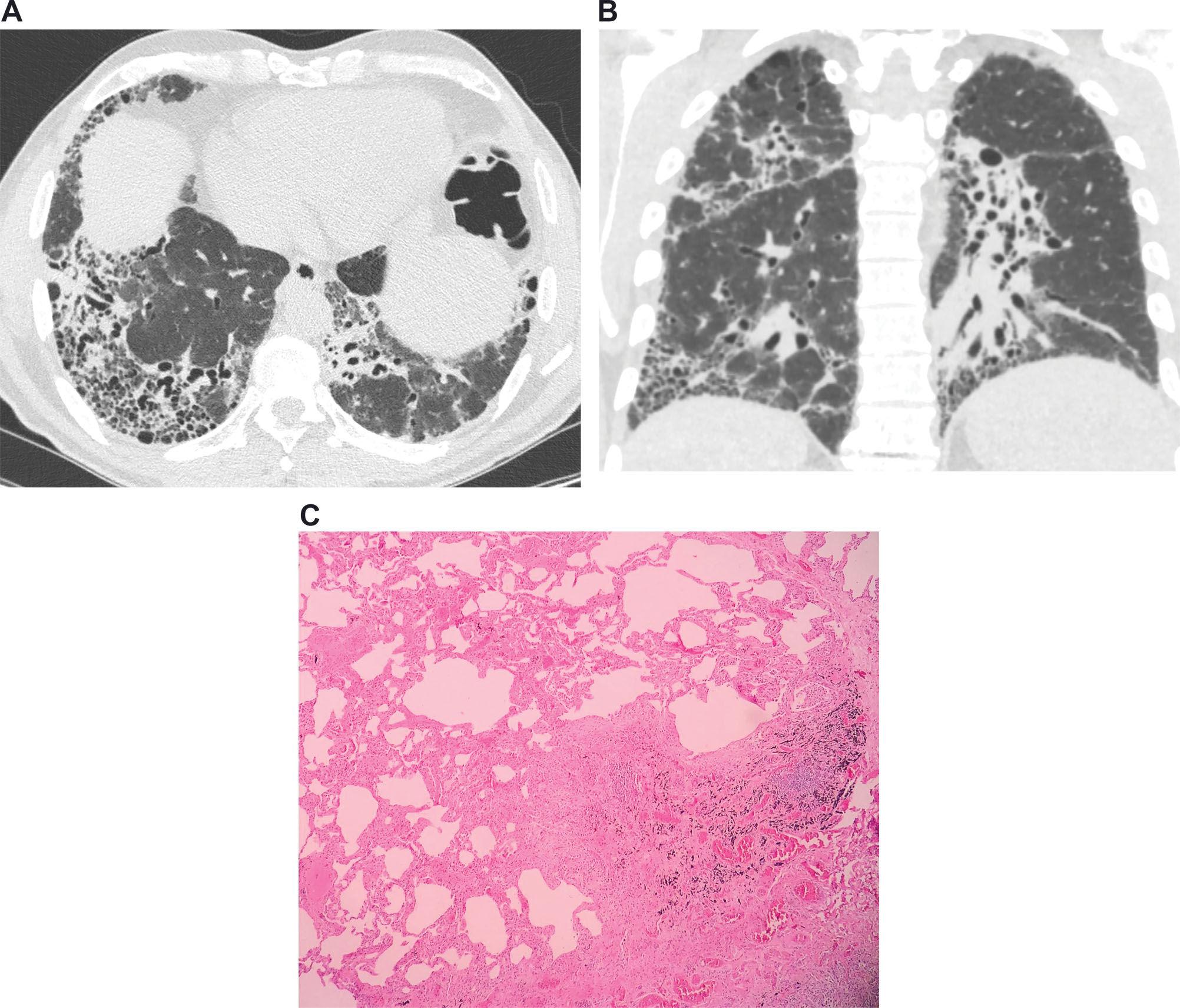 Imaging in idiopathic pulmonary fibrosis: diagnosis and mimics | Clinics